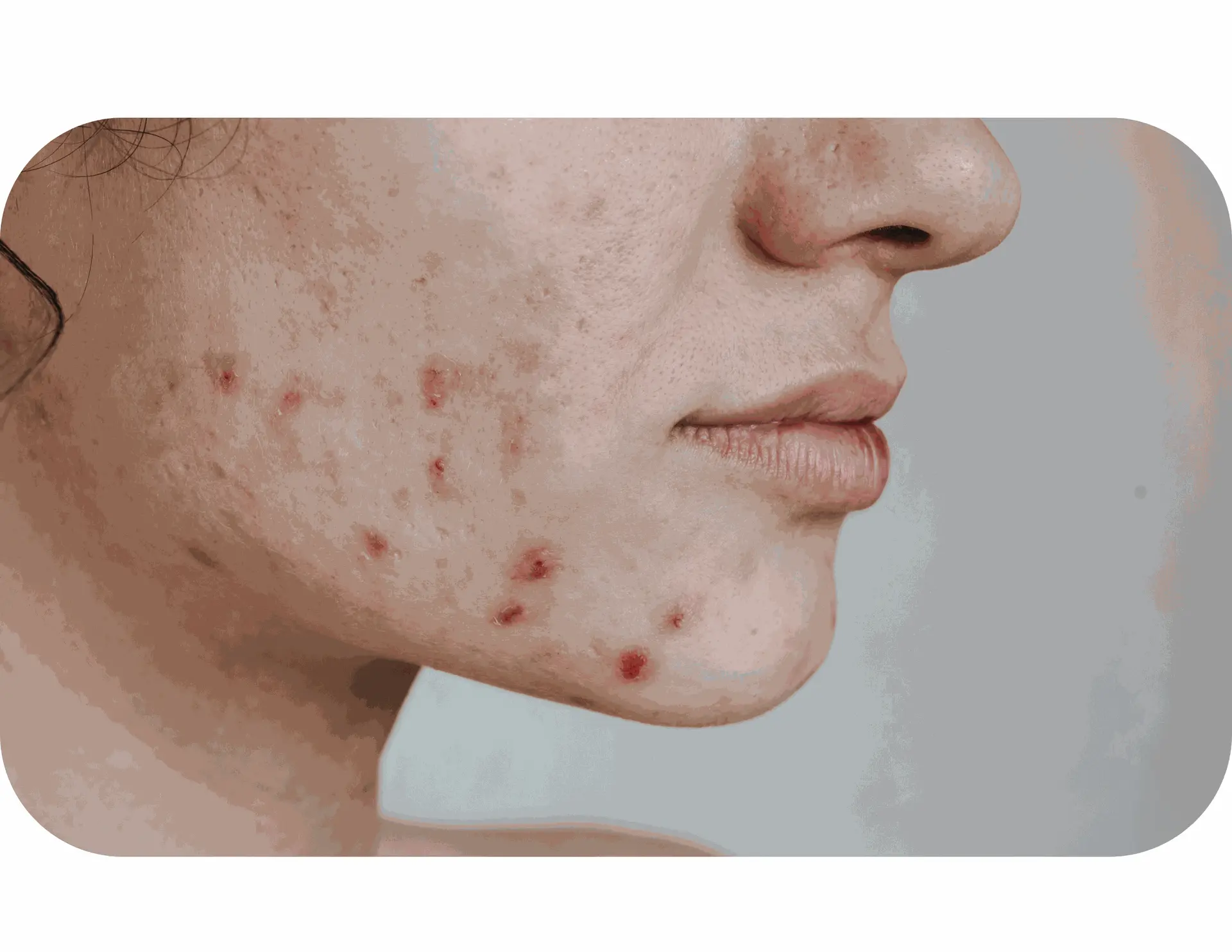 Piel acneica: consejos y rutina completa para su cuidado | Bioterapeuticos